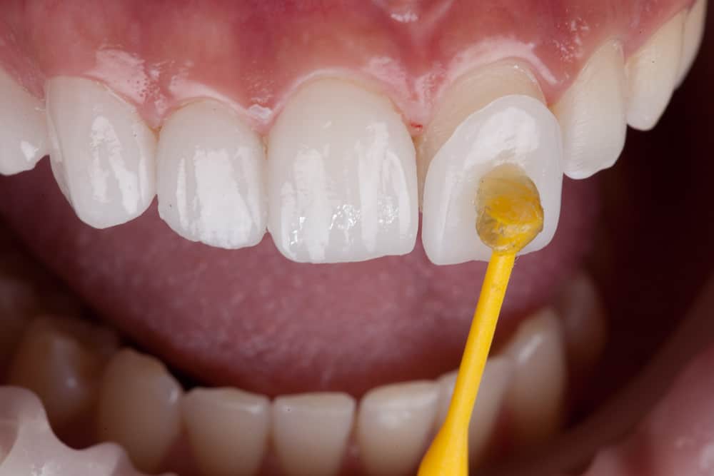 ¿Cuánto duran las carillas dentales? | Domus Dental - Domus Dental