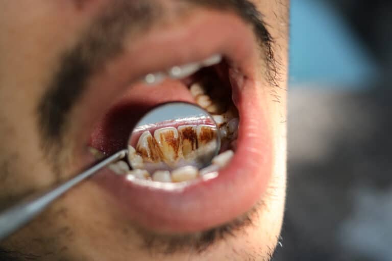 ¿Cómo afecta el tabaco a los dientes? | Domus Dental - Domus Dental